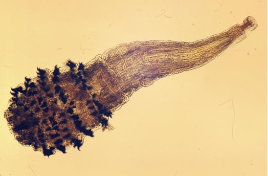 Crusted/Norwegian Scabies & Botflies Inside Human Bodies